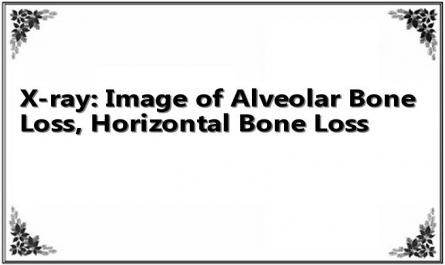 X-ray: Image of Alveolar Bone Loss, Horizontal Bone Loss